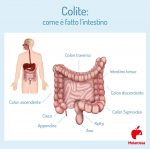 Colite: cos'è, sintomi, cause, cure, alimentazione giusta