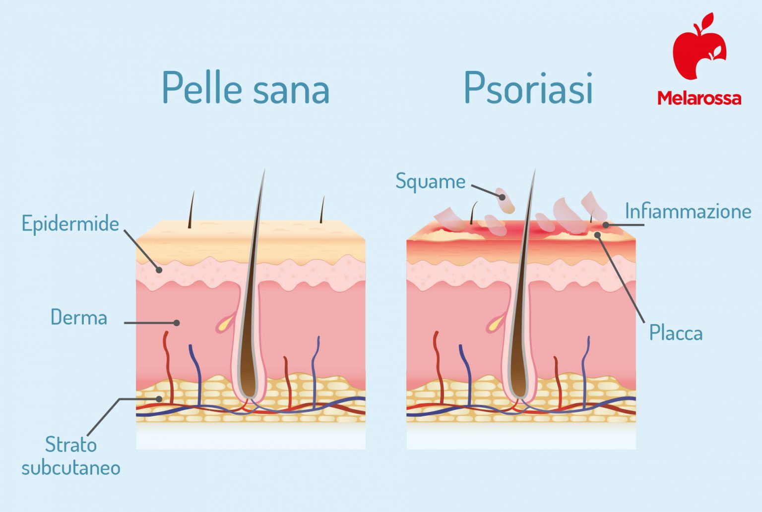 Psoriasi: cos'è, sintomi, tipi, cause, diagnosi e cura per questa patologia