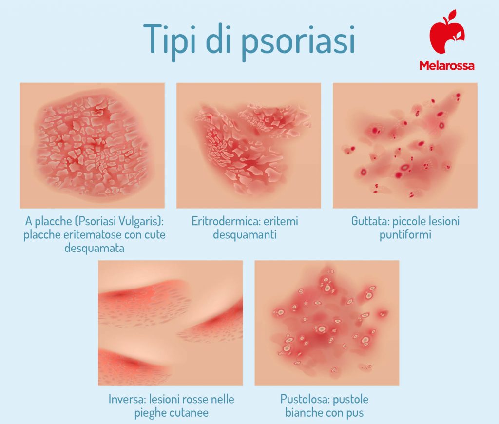 Psoriasi: cos'è, sintomi, tipi, cause, diagnosi e cura per questa patologia