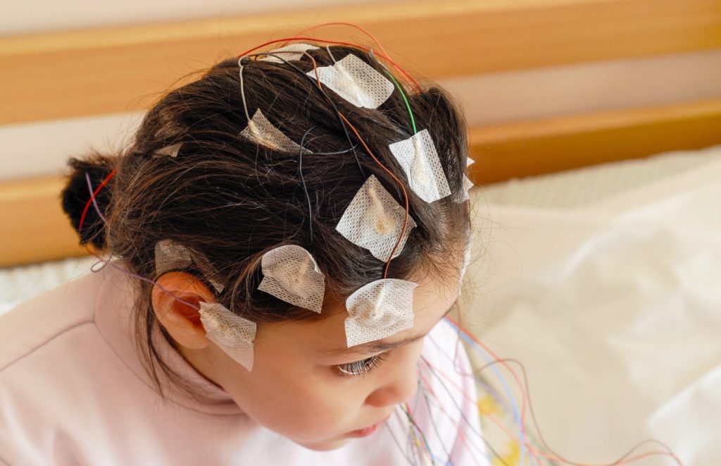 Epilessia: cos’è, sintomi, diagnosi, tipi e sindrome epilettiche