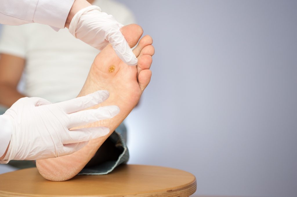 Verruche: cosa sono, sintomi, cause, cura e come prevenirle