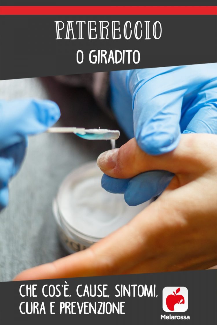 Patereccio o giradito: che cos’è, cause, sintomi, cura e prevenzione