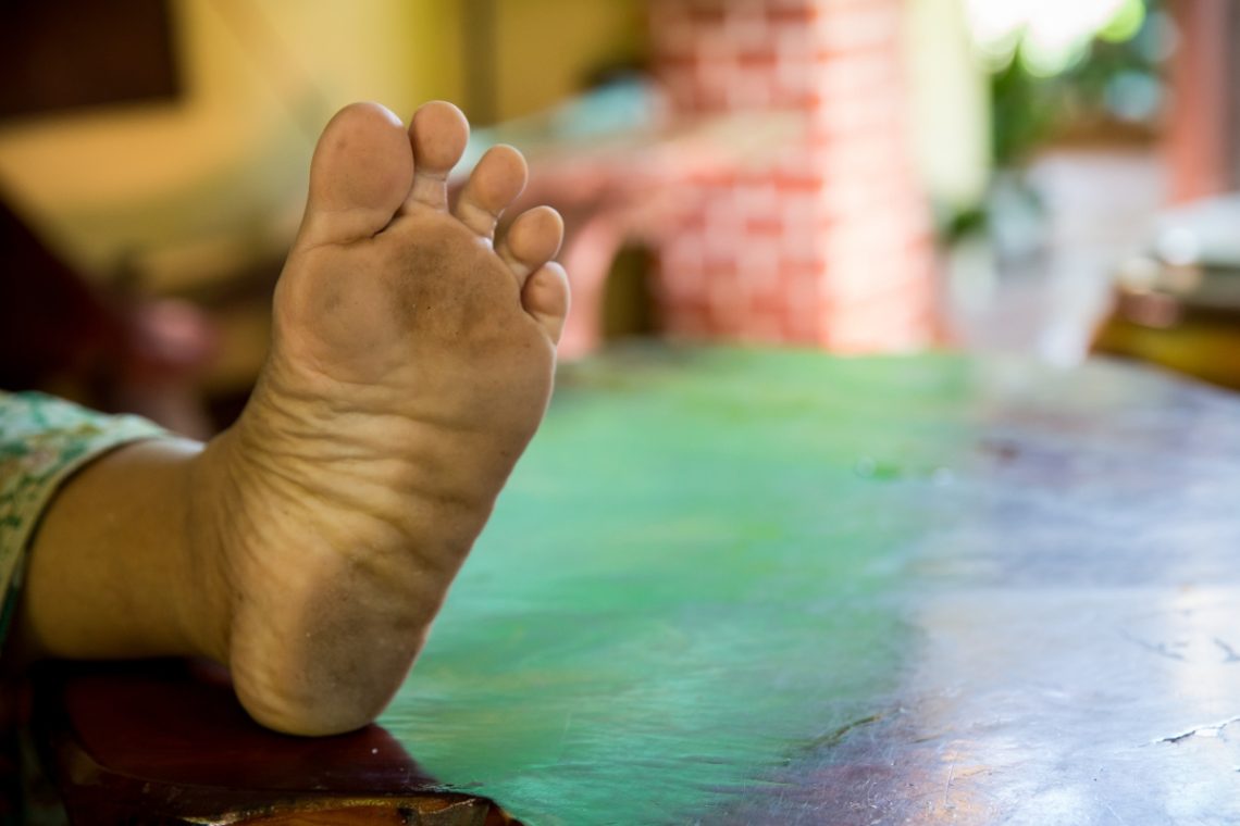 Patereccio o giradito: che cos’è, cause, sintomi, cura e prevenzione