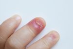 Patereccio o giradito: che cos’è, cause, sintomi, cura e prevenzione