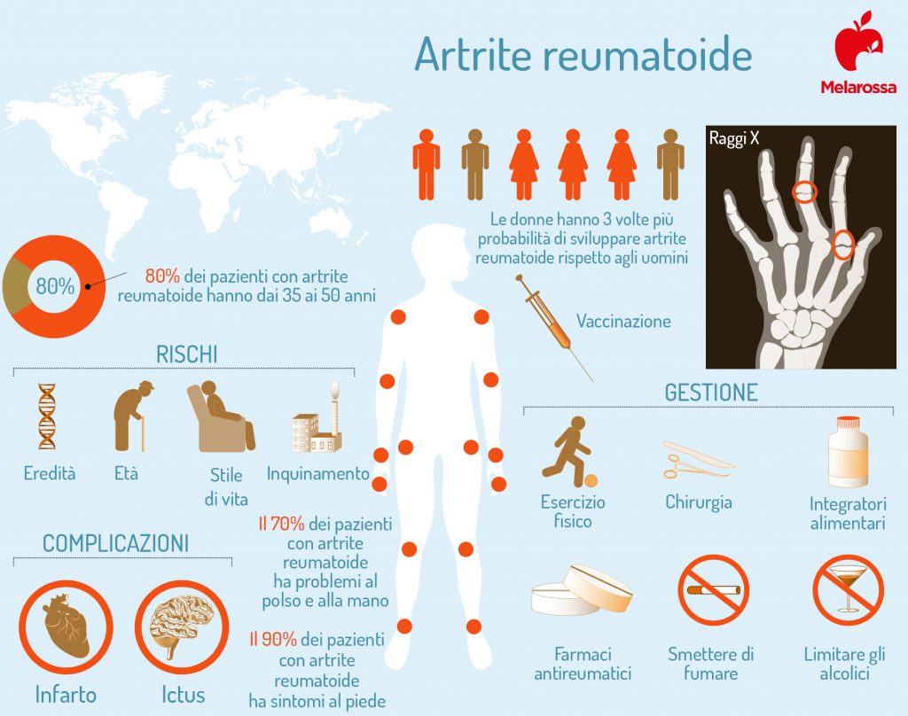 Artrite reumatoide: che cos’è, cause e fattori di rischio, sintomi, cure