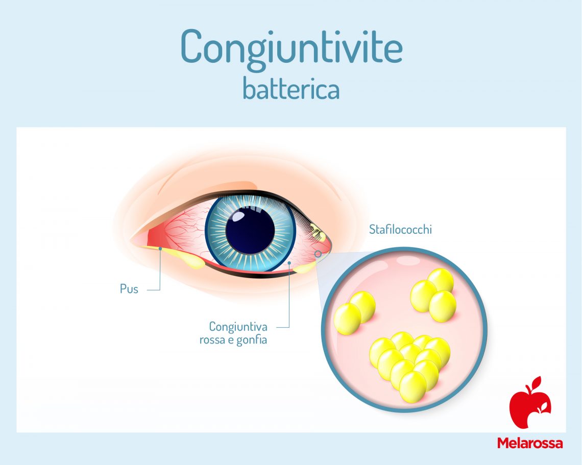 Congiuntivite: cause, i sintomi e le cure possibili da effettuare