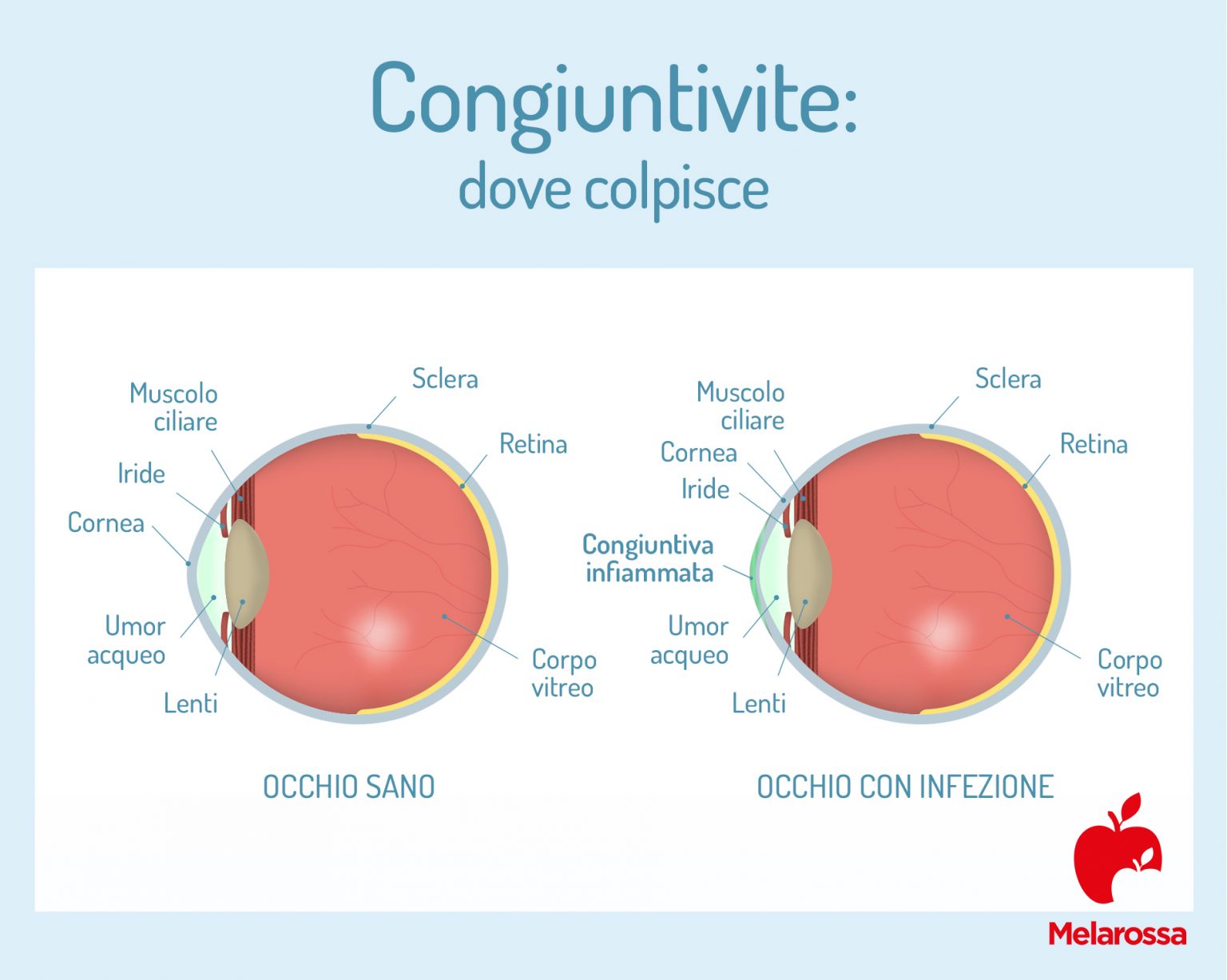 Congiuntivite Cause I Sintomi E Le Cure Possibili Da Effettuare congiuntivite-cause-i-sintomi-e-le-cure-possibili-da-effettuare