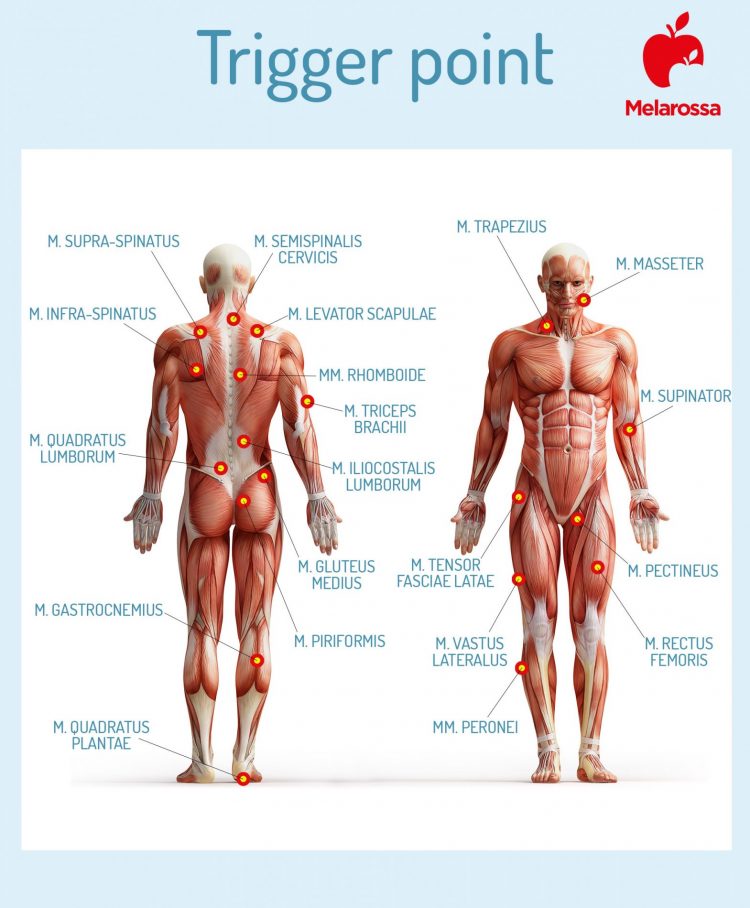 Trigger point: cosa sono, caratteristiche, tipi, sintomi, trattamenti