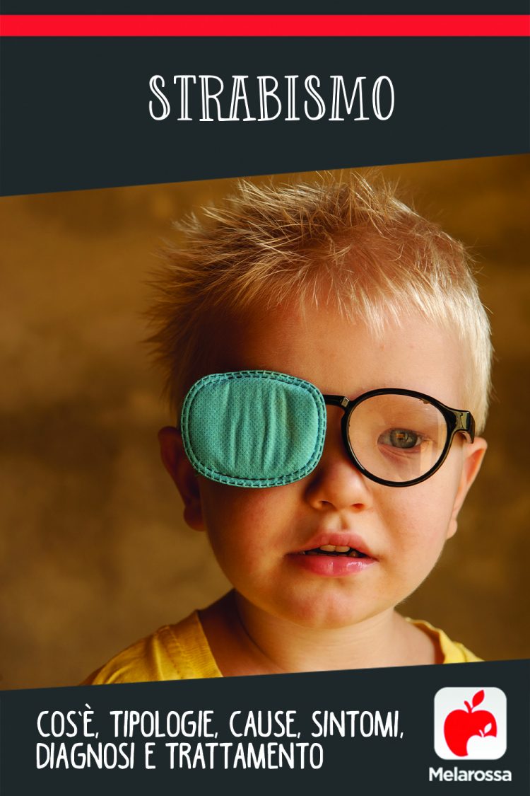 Strabismo: cos’è, tipologie, cause, sintomi, diagnosi e trattamento