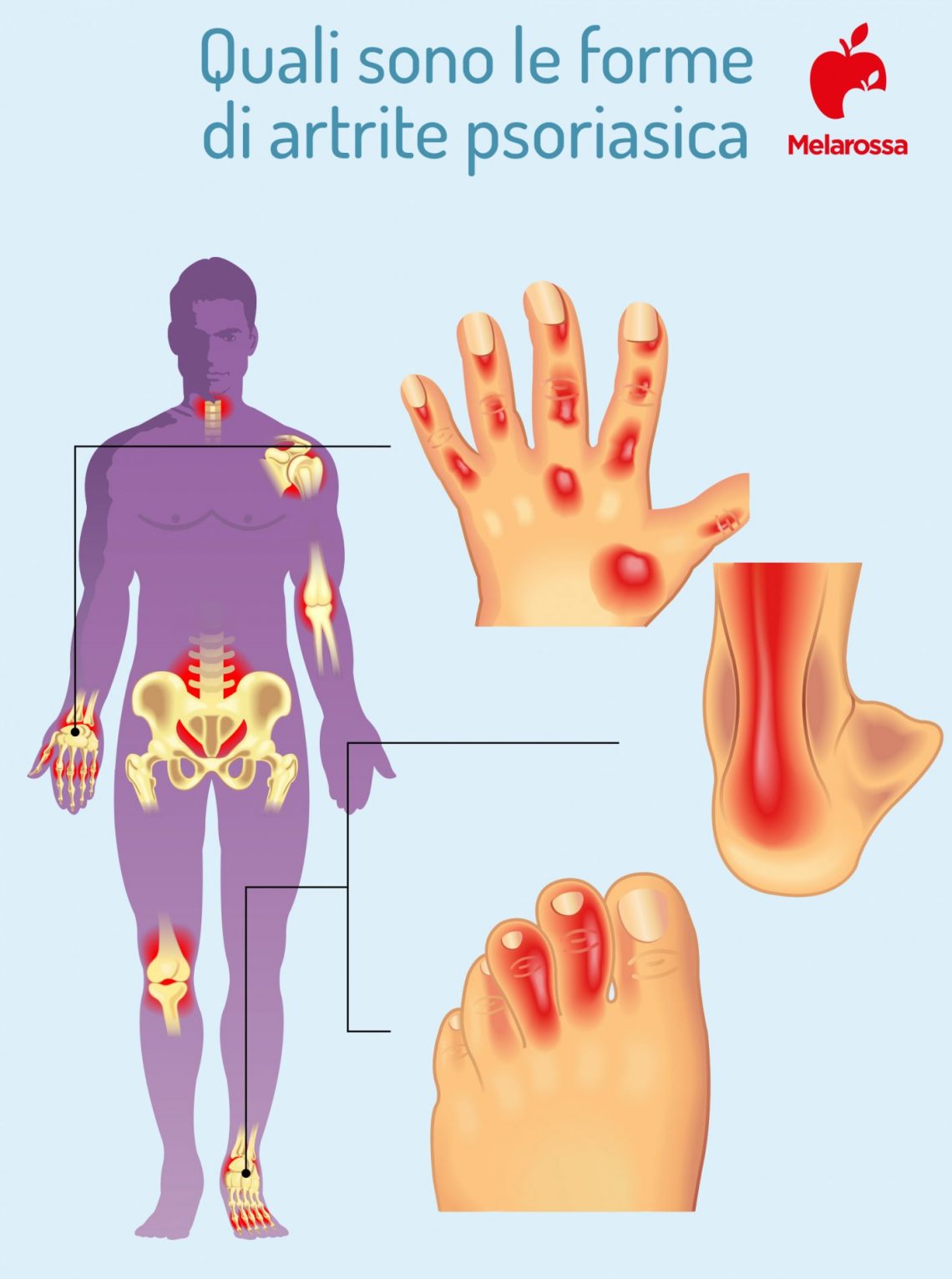Artrite psoriasica: cos’è, cause, sintomi, diagnosi e cure - Melarossa