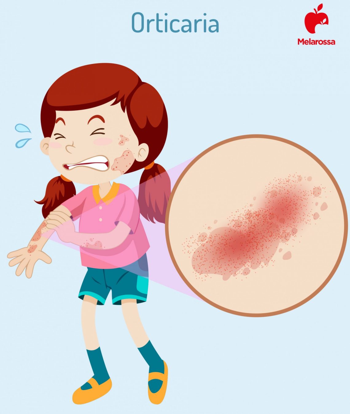 Orticaria: cos’è, classificazione, cause, sintomi, trattamenti e ...