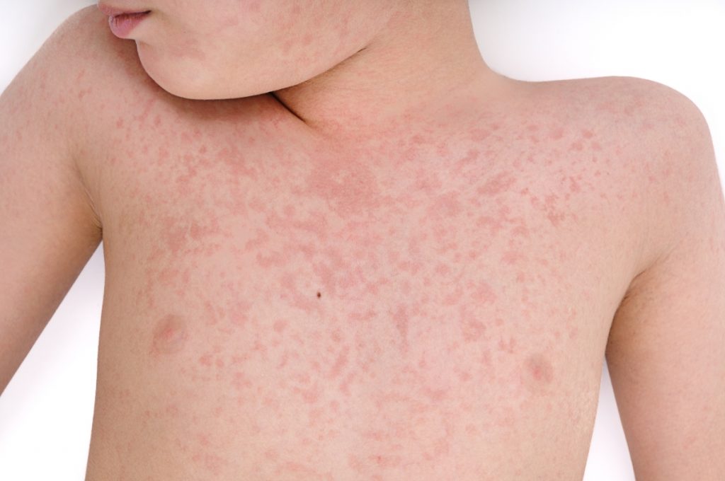 Orticaria: cos’è, classificazione, cause, sintomi, trattamenti e ...