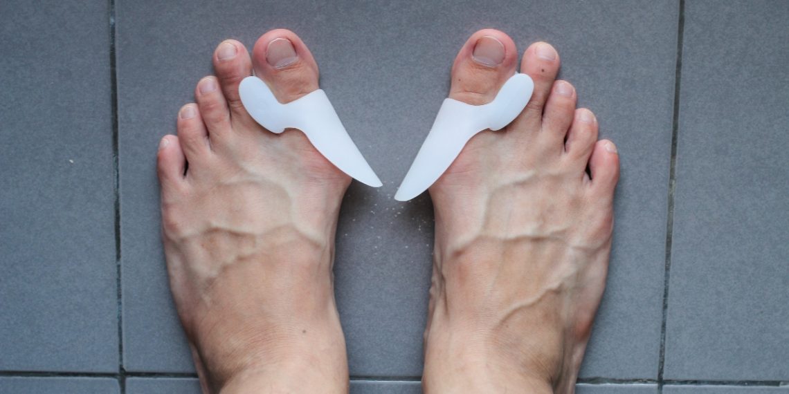 Alluce valgo: cos'è, cause, sintomi, prevenzione e cure - Melarossa