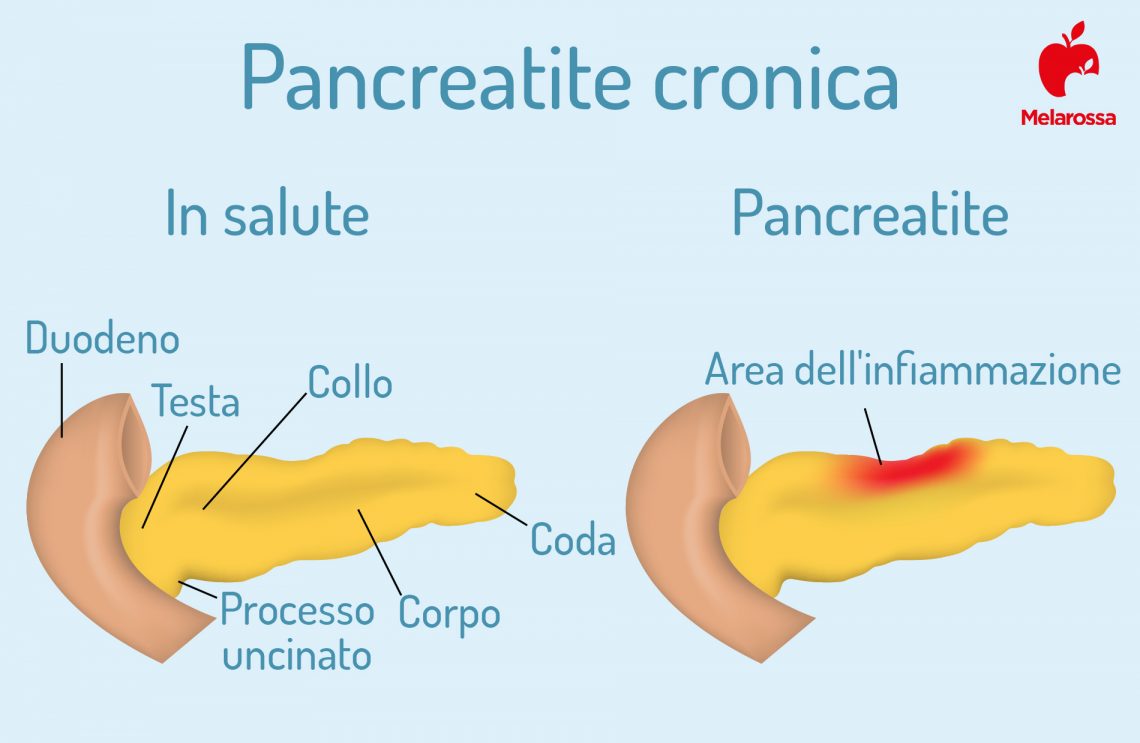 Pancreatite: come riconoscere l'infiammazione del pancreas