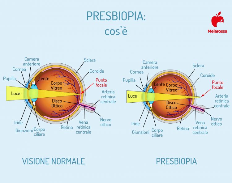 Presbiopia: cos’è, sintomi, cause, età di insorgenza, correzioni e cura