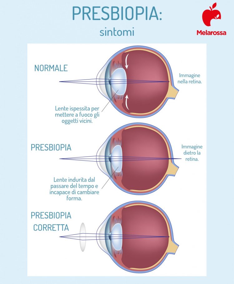 Presbiopia: cos’è, sintomi, cause, età di insorgenza, correzioni e cura