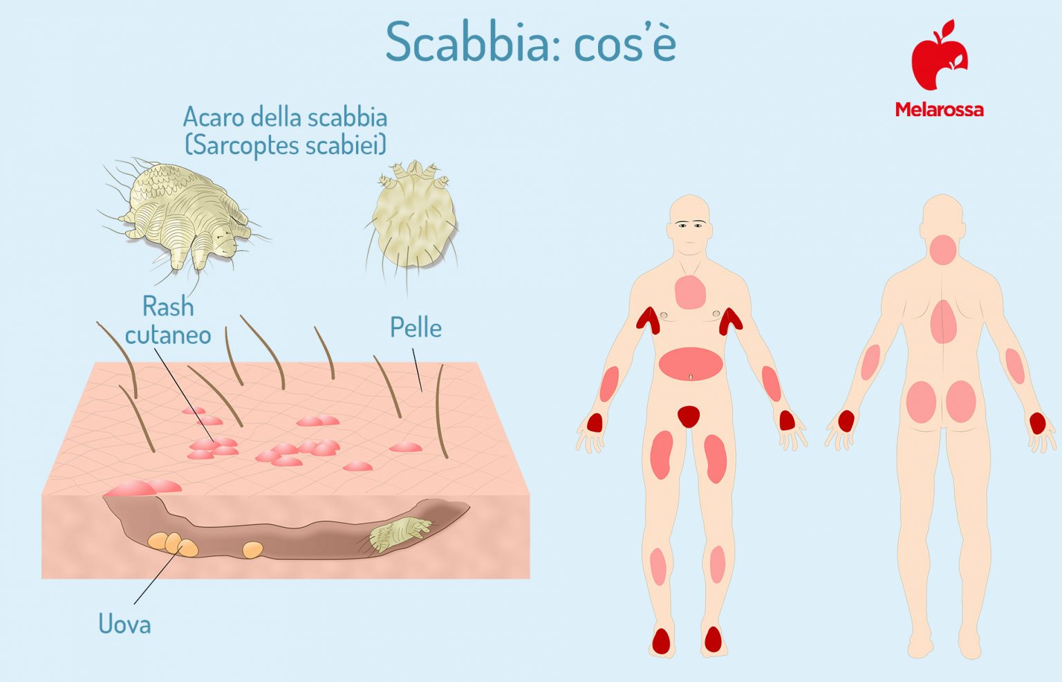 Scabbia: cos’è, come si trasmette, sintomi, diagnosi, cure e prevenzione