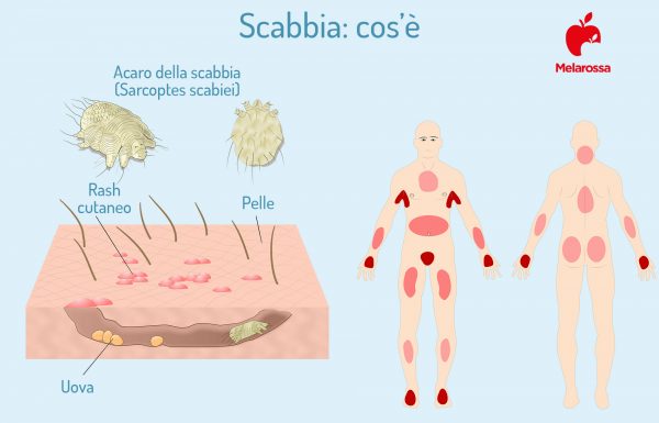 Scabbia: cos’è, come si trasmette, sintomi, diagnosi, cure e prevenzione