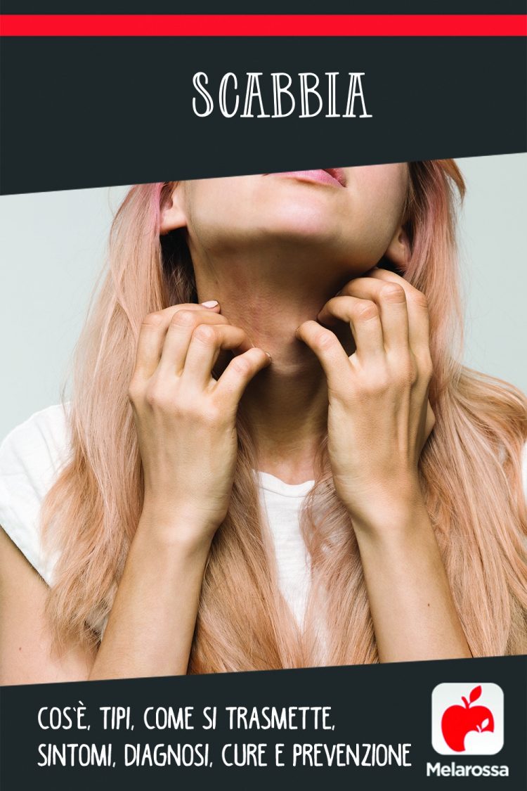 Scabbia: cos’è, come si trasmette, sintomi, diagnosi, cure e prevenzione