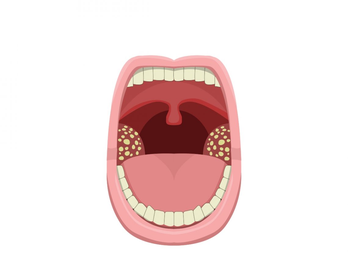Tonsillite: cos’è, sintomi, cause, complicazioni, cure e prevenzione
