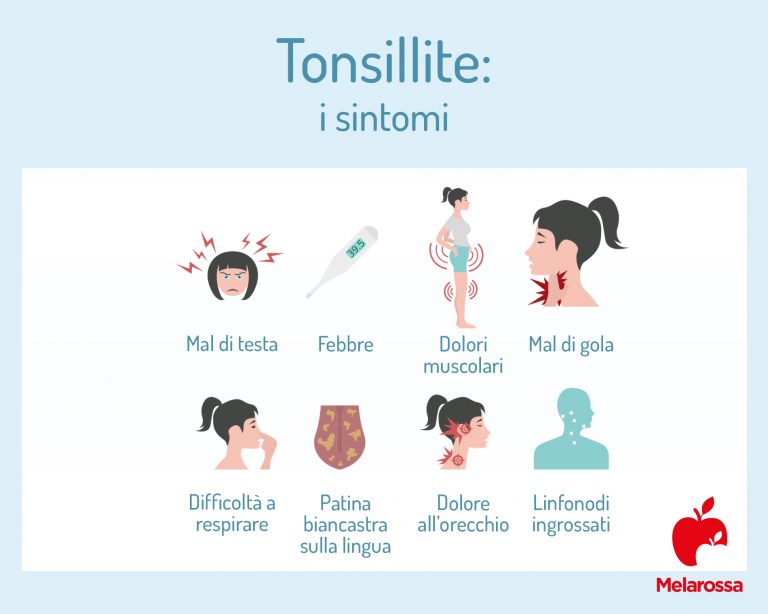 Tonsillite: cause, sintomi, cure e quanto dura - Melarossa
