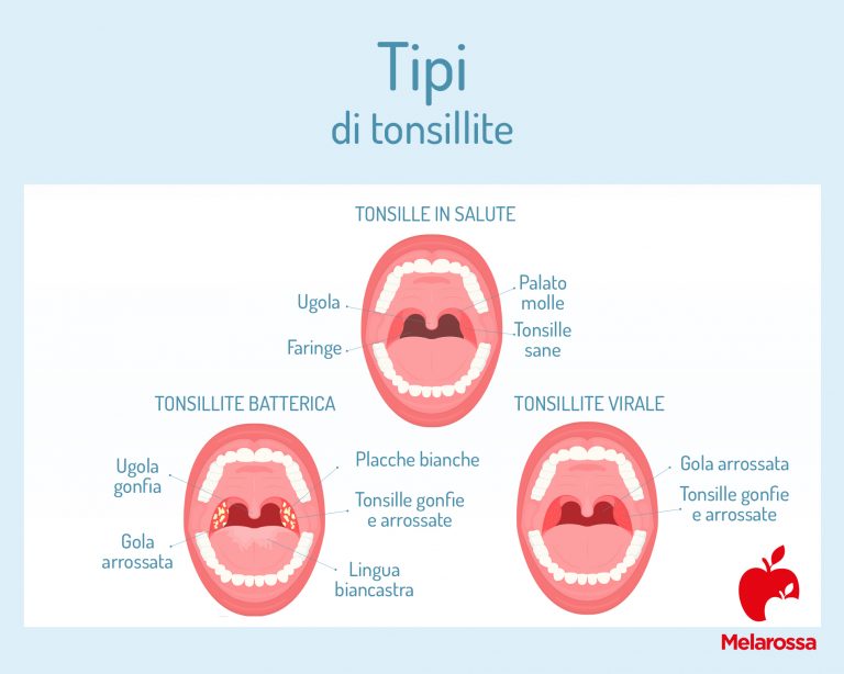 Tonsillite: cause, sintomi, cure e quanto dura - Melarossa