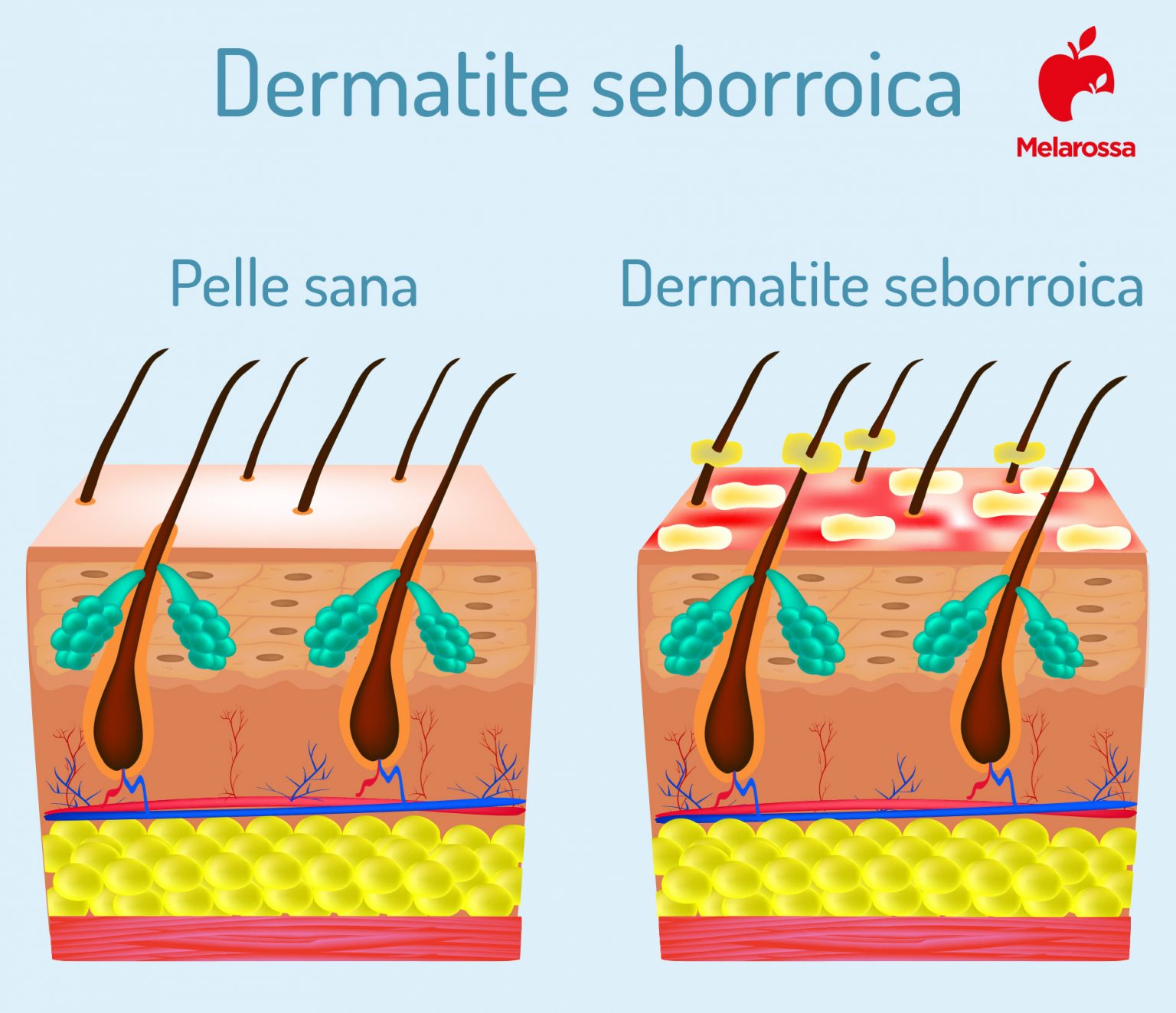 Dermatite seborroica: cause, sintomi, trattamenti e rimedi naturali