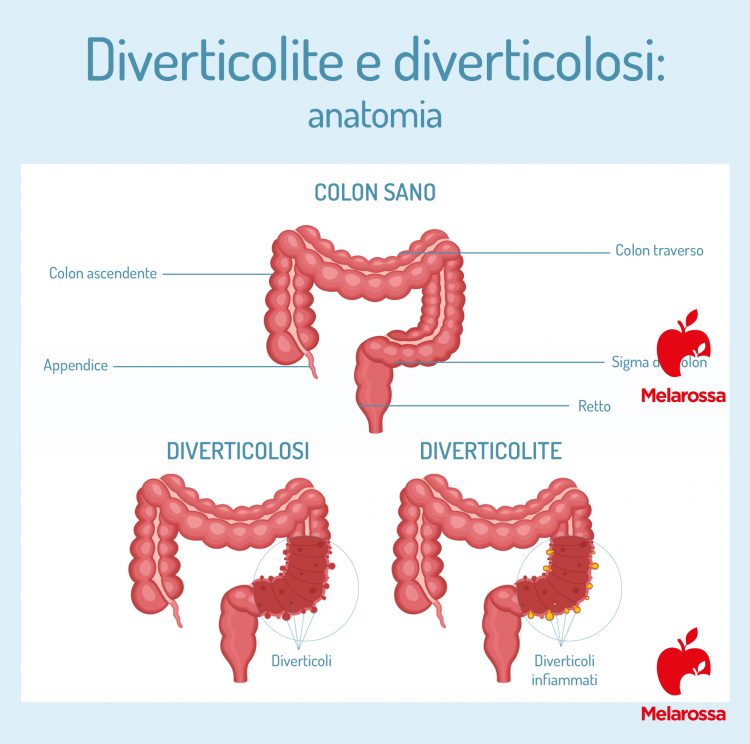 Diverticolosi e diverticolite: cause, sintomi, cure e dieta giusta