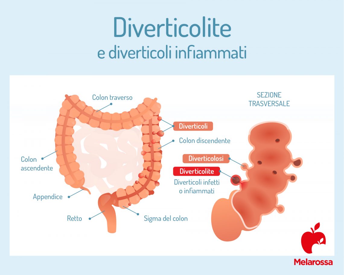Diverticolosi e diverticolite: cause, sintomi, cure e dieta giusta