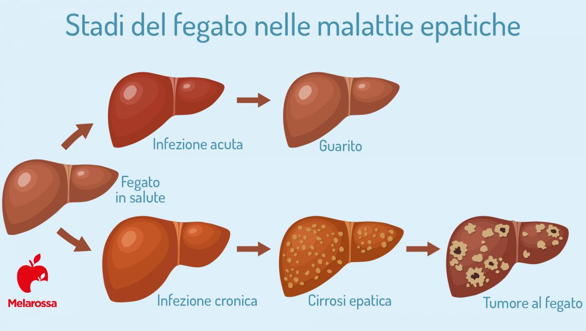 Epatite C: cos’è, cause e sintomi, contagio, diagnosi, cure e prevenzione