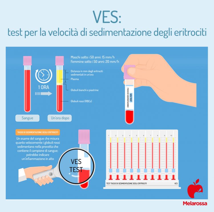 VES: perché misurarla, valori normali e alti, quando preoccuparsi
