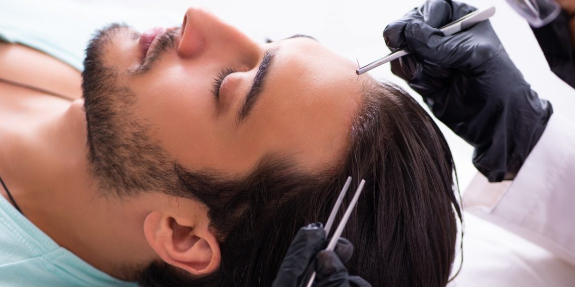 Trapianto capelli: cos'è, quanto costa e come funziona - Melarossa