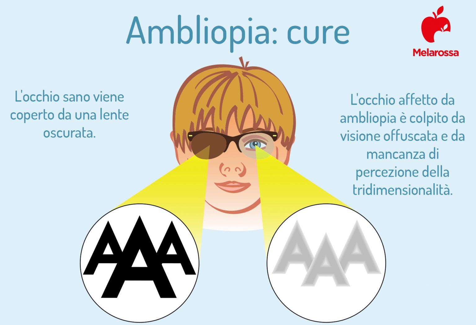 Ambliopia: cos’è, come si manifesta, cause, diagnosi e cure