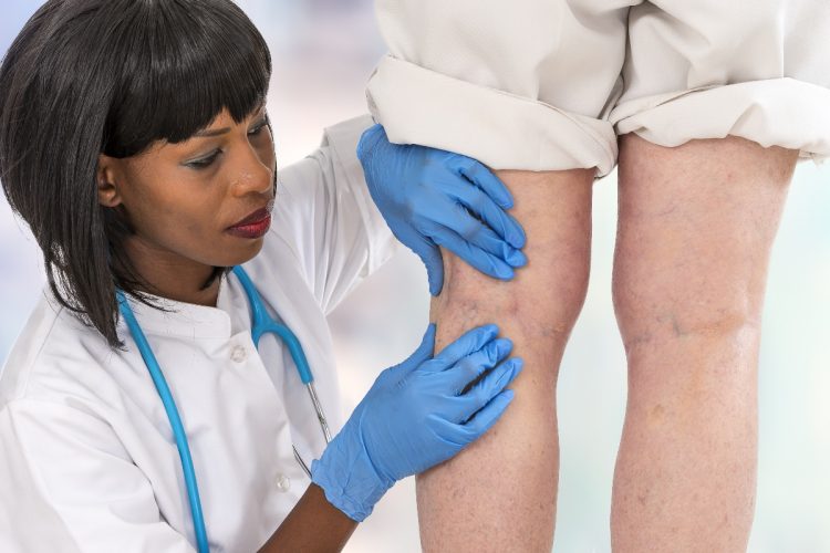 Flebite: cos'è, sintomi, cause, cura e prevenzione - Melarossa