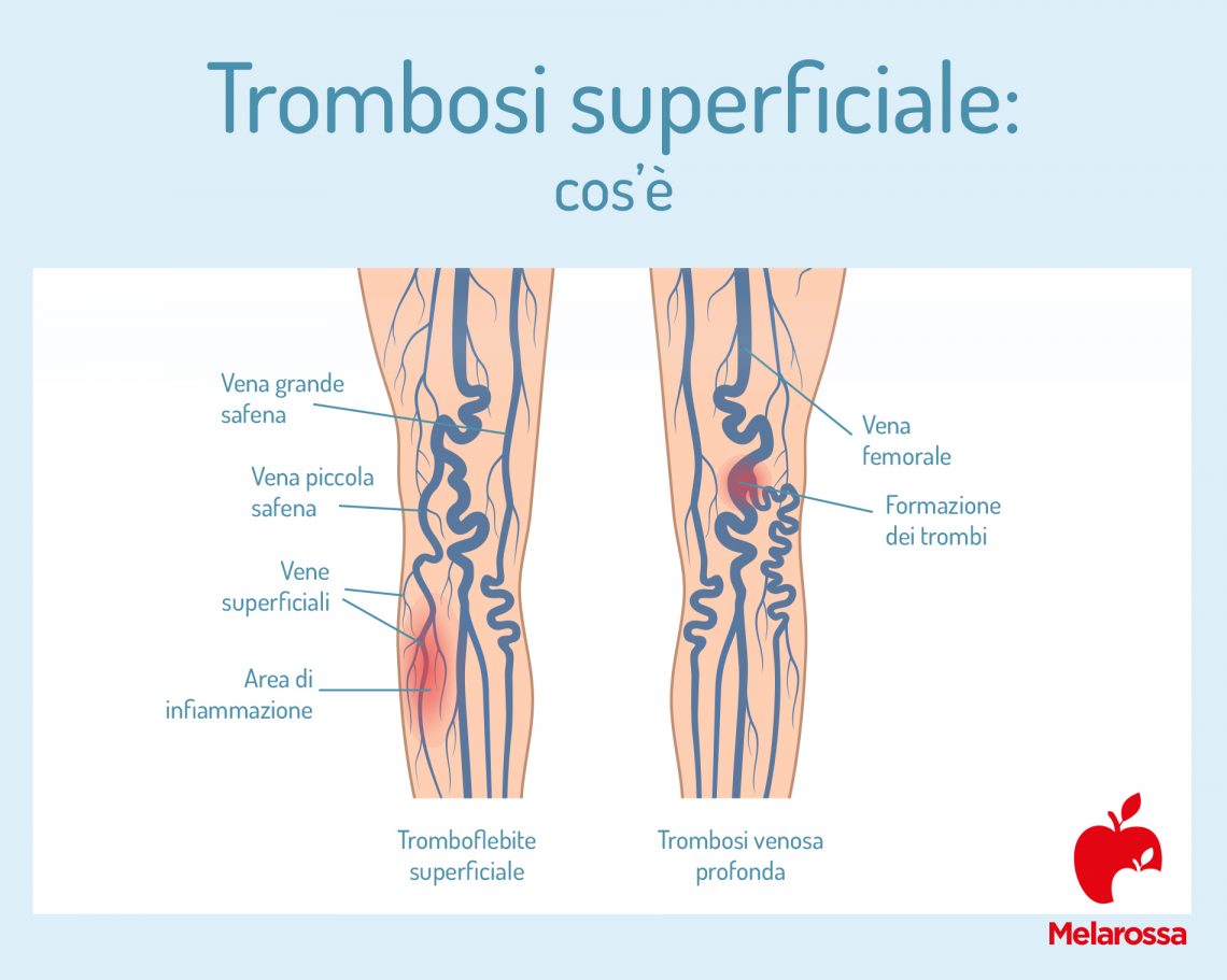 Flebite: cos'è, sintomi, cause, cura e prevenzione - Melarossa