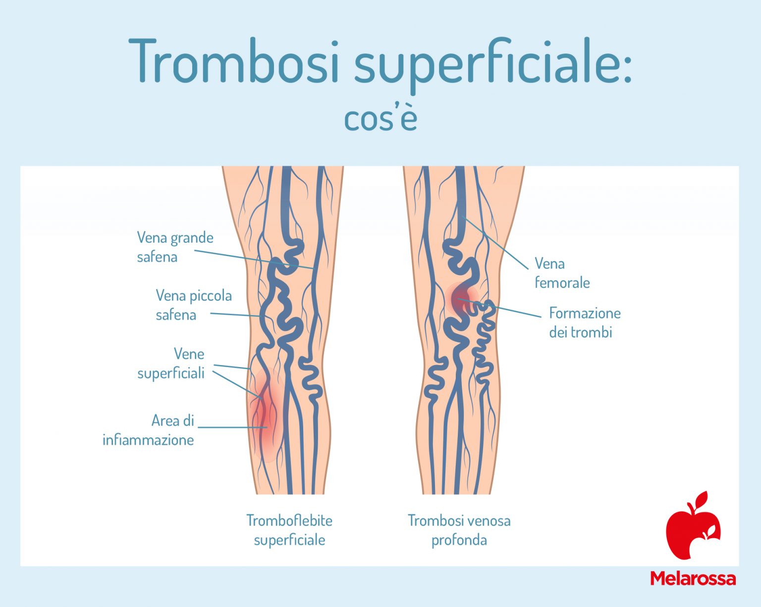 Flebite: cos'è, sintomi, cause, cura e prevenzione - Melarossa