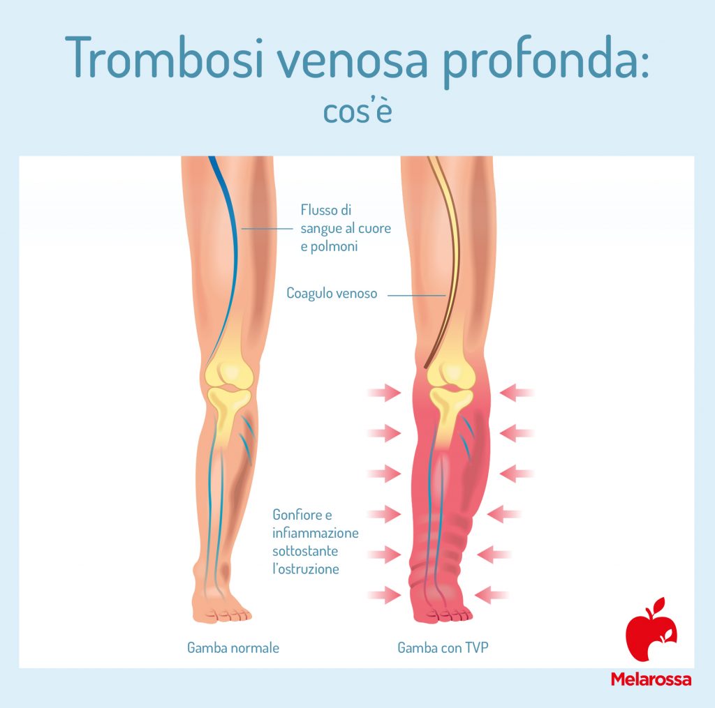 Flebite: cos'è, sintomi, cause, cura e prevenzione - Melarossa