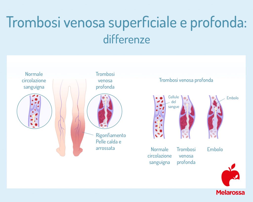 Flebite: cos'è, sintomi, cause, cura e prevenzione - Melarossa