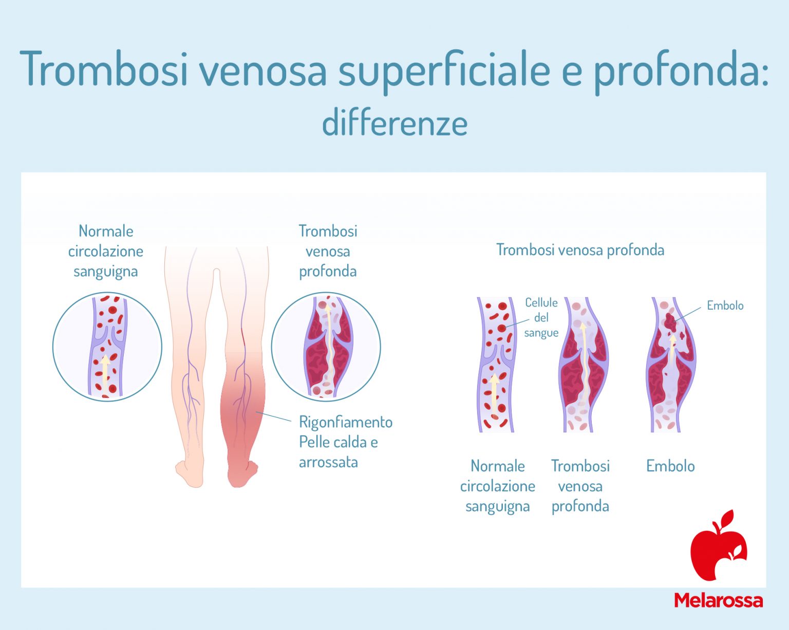 Flebite: cos'è, sintomi, cause, cura e prevenzione - Melarossa