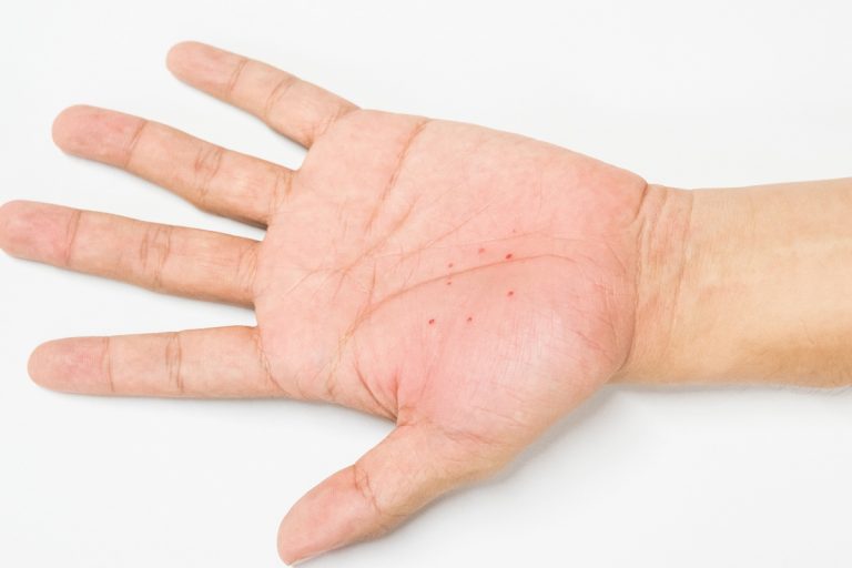 Disidrosi a mani e piedi: cos’è, cause, sintomi, terapia e rimedi