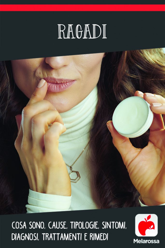 Ragadi: cosa sono, cause, tipologie, sintomi, diagnosi, trattamenti e ...