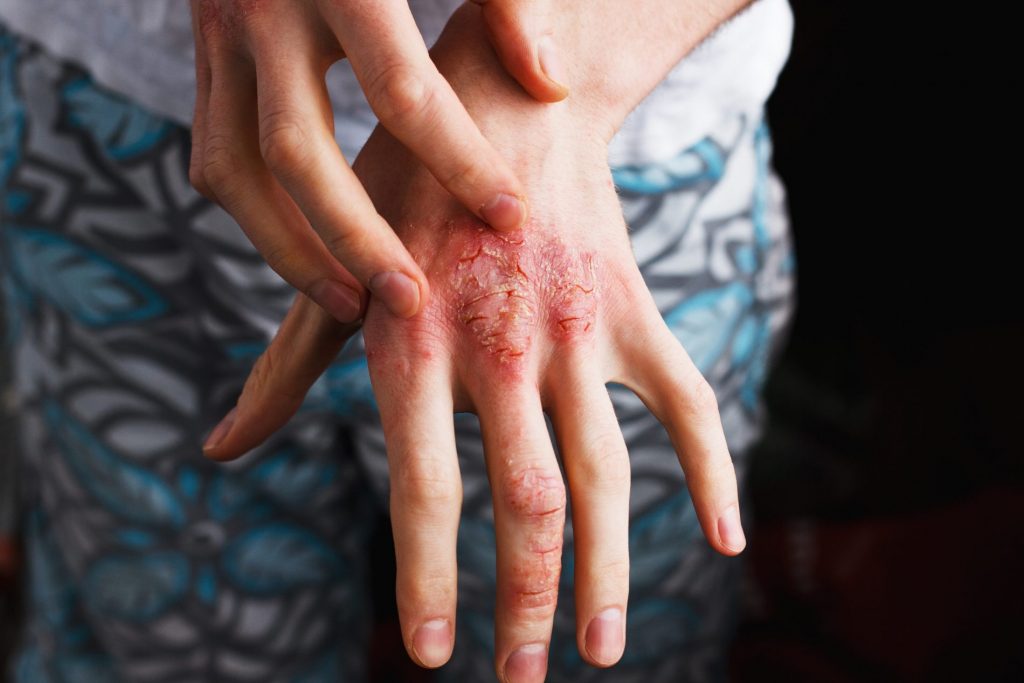 Dermatite: cos’è, tipologie principali, cause, sintomi, cura e trattamento