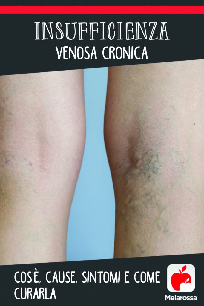 Insufficienza venosa cronica: cos'è, cause, sintomi e come curarla