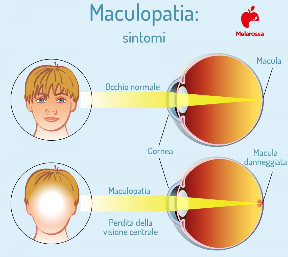 Maculopatia: cos’è, cause, sintomi, forme, esami e diagnosi, cure