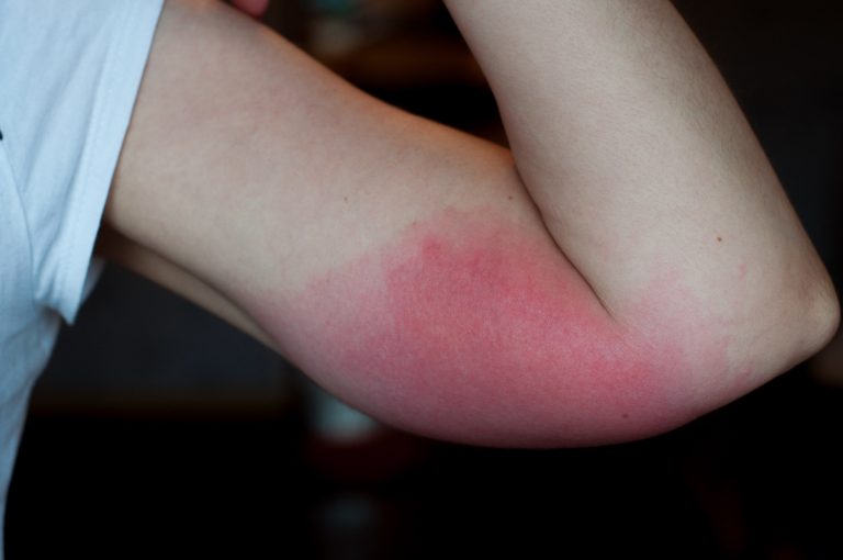 Punture di insetti: come riconoscerle, cosa fare e consigli per prevenirle