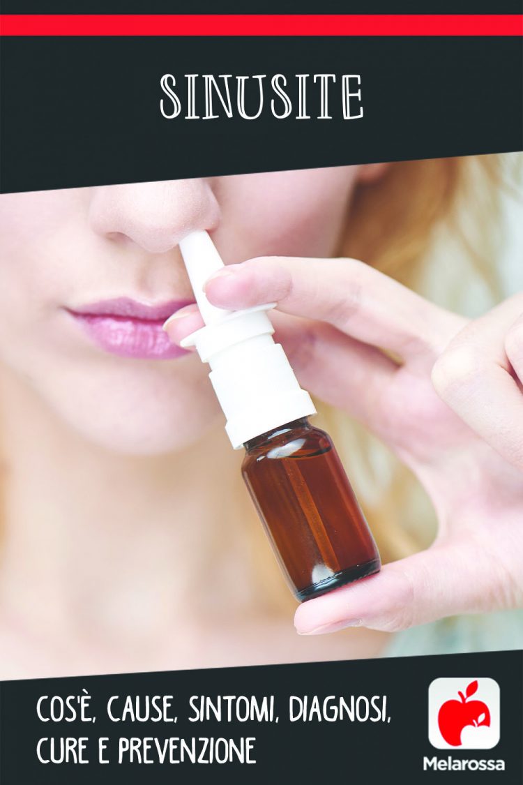 Sinusite: cos'è, cause, sintomi, diagnosi, cure e prevenzione