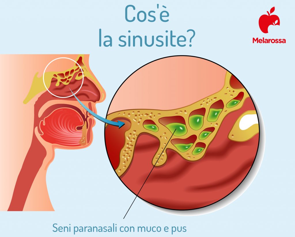 Sinusite: cos'è, sintomi, rimedi e come si cura