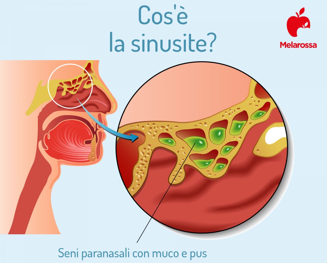Sinusite: cos'è, sintomi, rimedi e come si cura