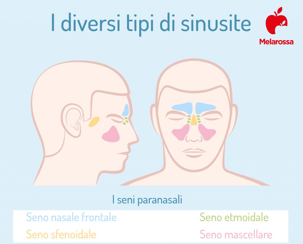 Sinusite: cos'è, sintomi, rimedi e come si cura