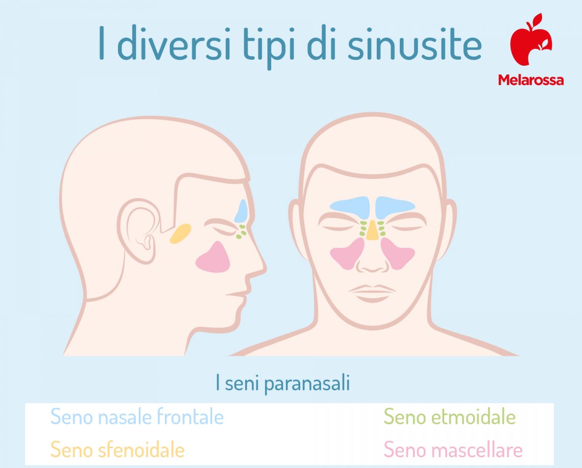 Sinusite: cos'è, sintomi, rimedi e come si cura